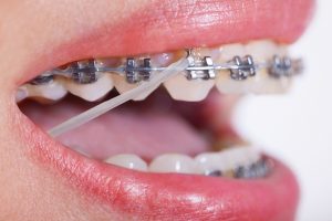 Brackets: wie festsitzende Zahnspangen Zähne zurechtrücken - HEROLD.at