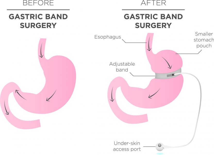 Magenband Operation Adipositas Übergewicht