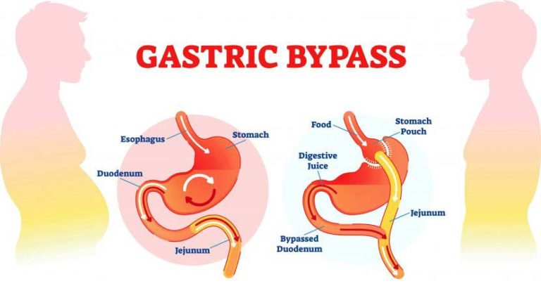 Magenbypass in Österreich | Wer zahlt, wie funktioniert es? - HEROLD