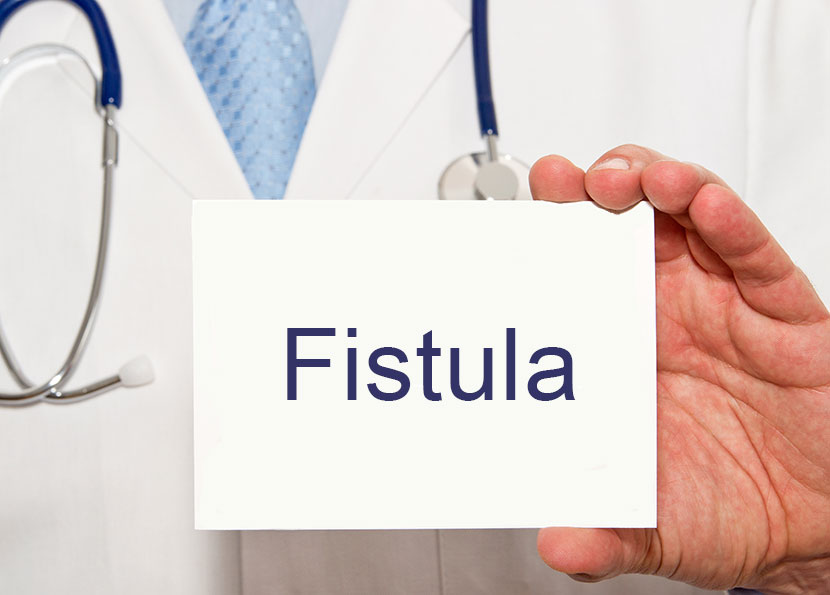 Fisteln: Erfolgreich behandeln und therapieren - HEROLD.at