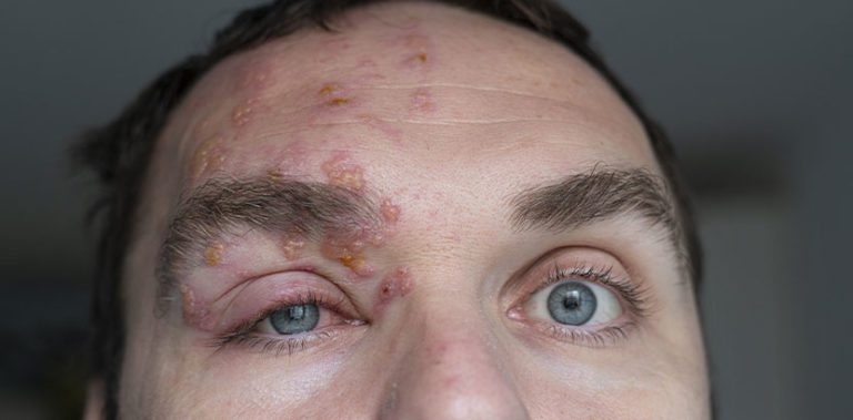 Gürtelrose behandeln: Ansteckung, Schmerzen, Impfung - HEROLD.at