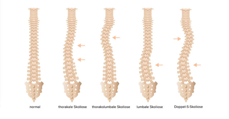 Skoliose: Ursachen, Symptome und Behandlung - HEROLD.at Skoliose: Ursachen, Symptome und Behandlung - HEROLD.at