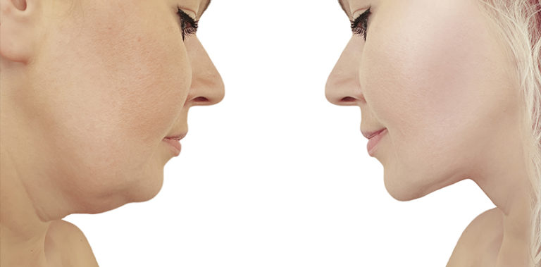 Doppelkinn loswerden: welche Möglichkeiten gibt es? - Herold Blog