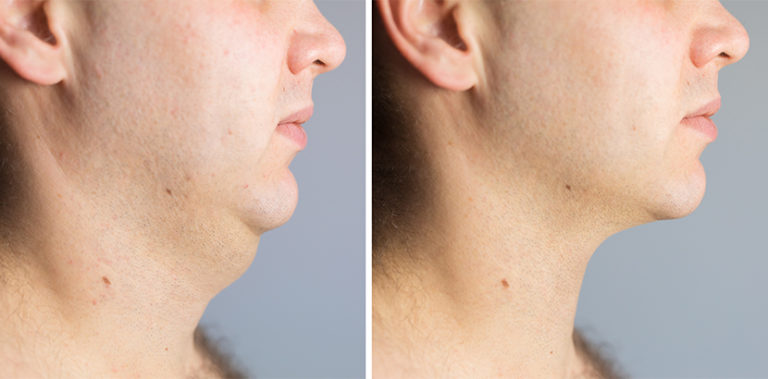 Doppelkinn loswerden: welche Möglichkeiten gibt es? - Herold Blog