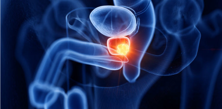 Prostatakrebs: alles zur Vorsorge ab 45 - HEROLD.at